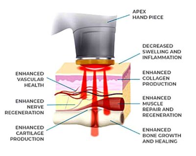 Aspen Apex Laser Therapy | Dr. Chiungos, Chiropractor, Chelmsford MA