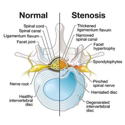 SpineMED® Decompression | Dr. Chiungos, Chiropractor, Chelmsford MA